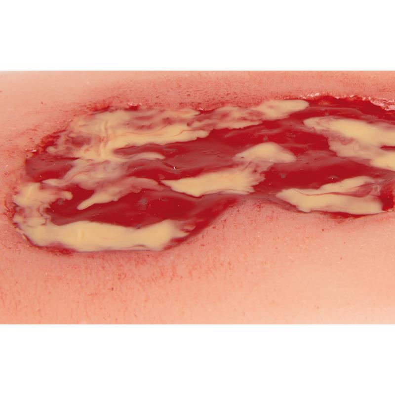 Molde "herida úlcera venosa de pierna en fase de exudación"