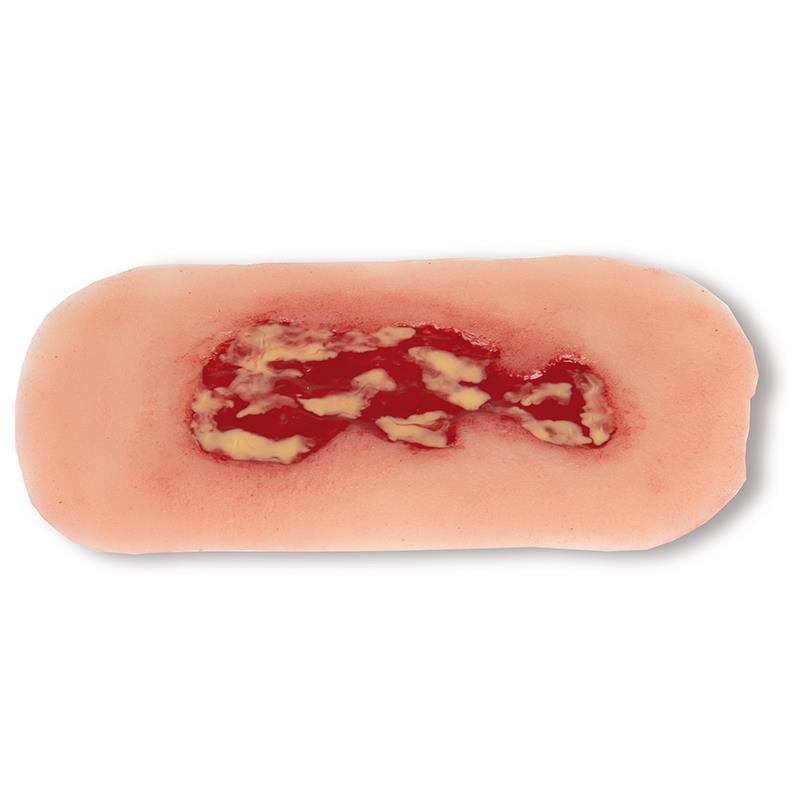 Molde "herida úlcera venosa de pierna en fase de exudación"